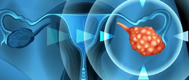 Ovarian Cancer - Liv Hospital